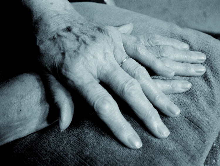 La Polyarthrite Rhumatoïde (PR) - Fondation Arthritis